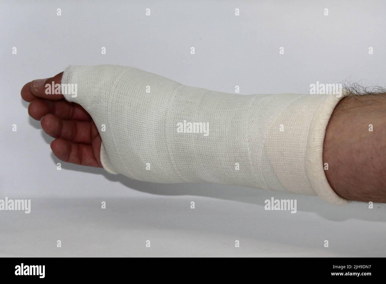 Right Hand Thumb and Wrist in a Hard Plaster Cast on White Background ...