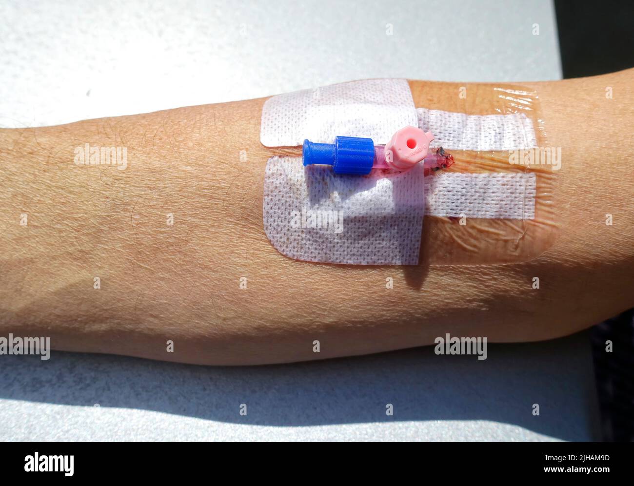 Peripheral venous access catheter hi-res stock photography and images ...