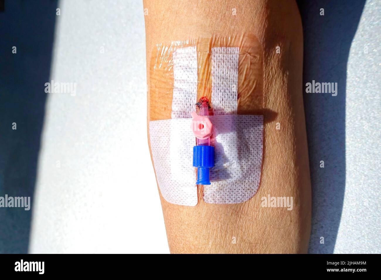 Peripheral venous catheter, Berlin, Germany Stock Photo - Alamy