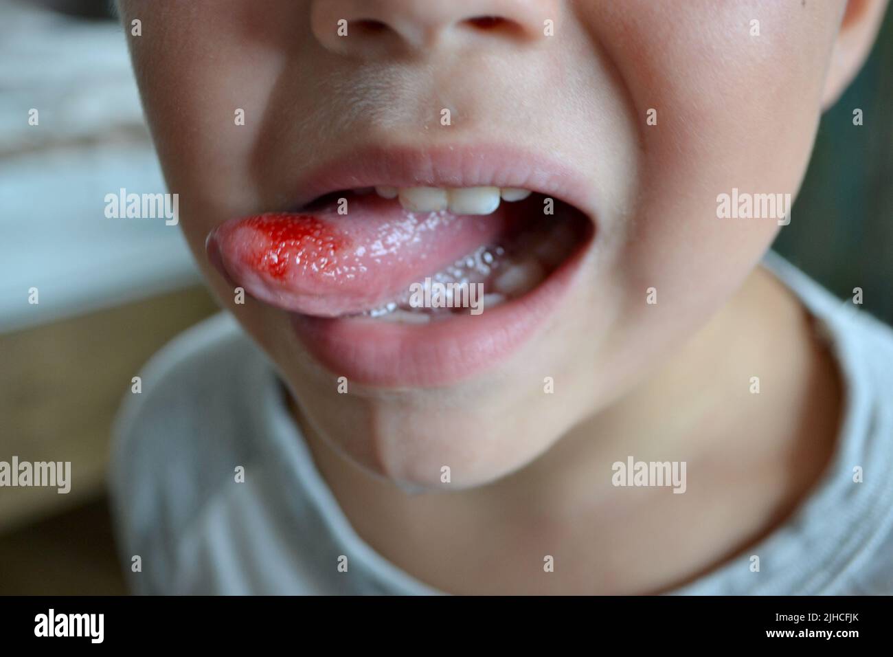 Child's bitten tongue. Close-up of lips, tongue, protrusion of blood ...