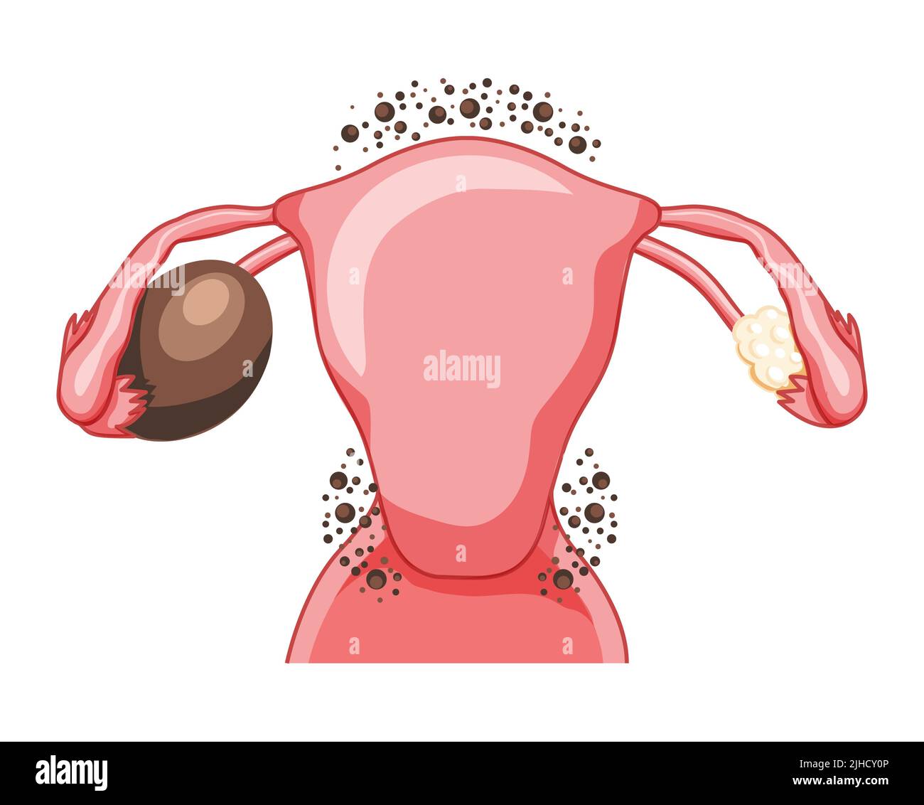 Ovarian endometriomas chocolate cysts Female reproductive system uterus ...