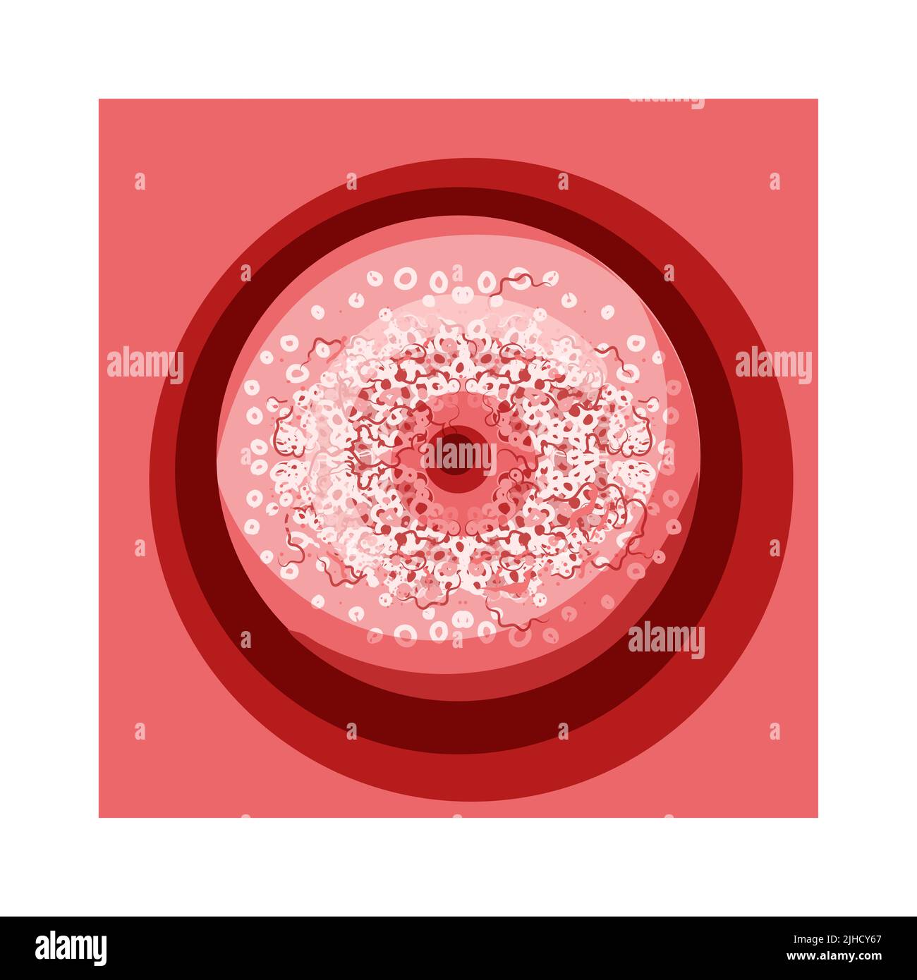 Cervical invasive cancer Dysplasia stage infographic Female ...