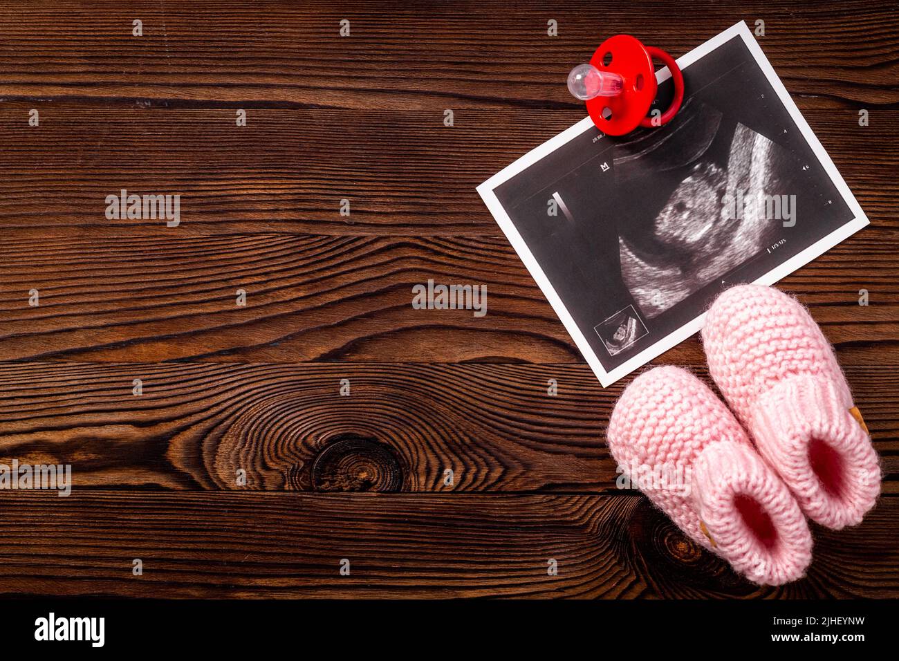 Pregnancy background. Baby accessories with ultrasound picture of ...