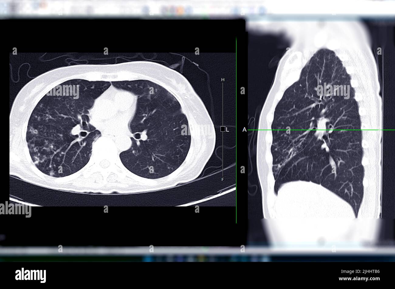 CT Chest or CT Scan of Lung Axial and Coronal View for diagnosis TB,tuberculosis and coronavirus ...