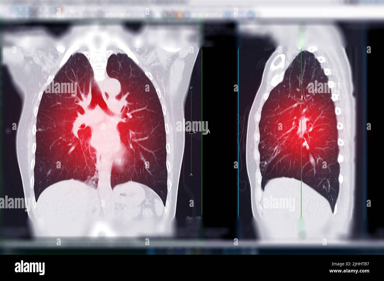 CT Chest or CT Scan of Lung Coronal and sagittal View for diagnosis TB ...