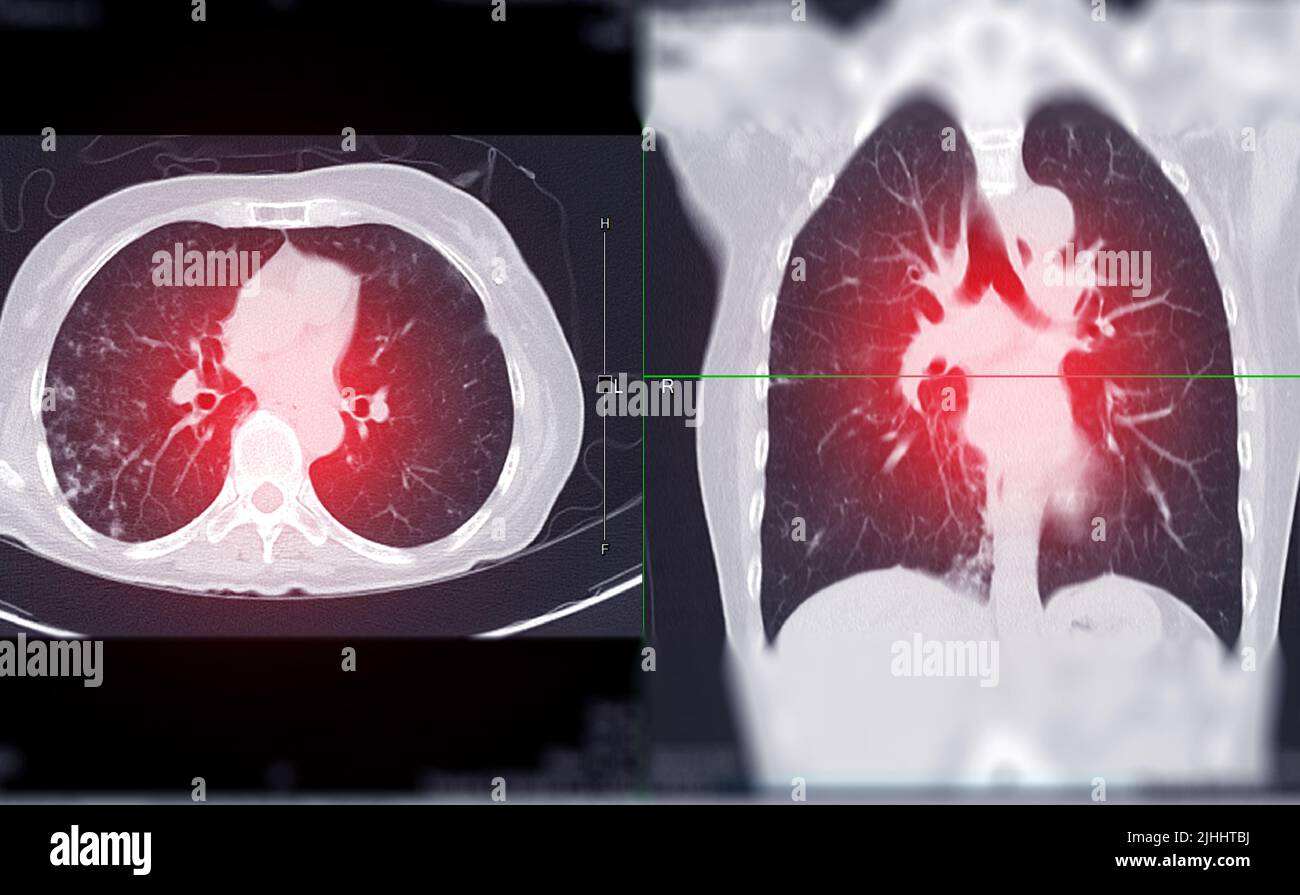 CT Chest or CT Scan of Lung Axial and sagittal View for diagnosis TB,tuberculosis and ...
