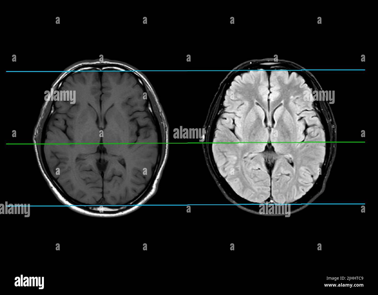 MRI brain compare axial T1W and T2W Flair plane for detect stroke ... MRI brain compare axial T1W and T2W Flair plane for detect stroke ...