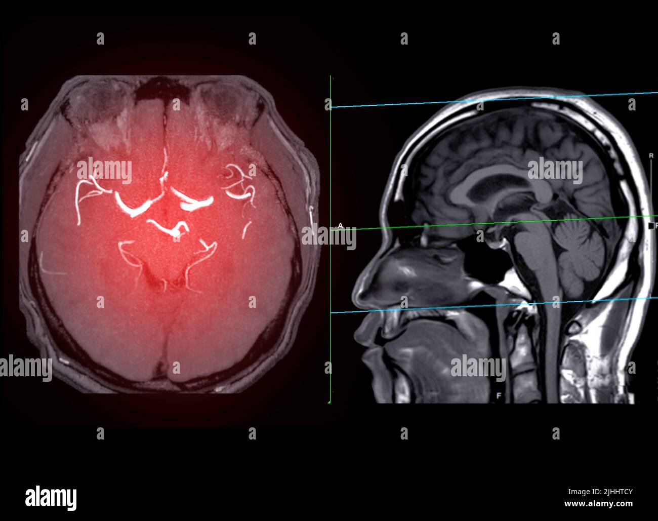 MRA Brain or Magnetic resonance angiography of the brain axial MIP view ...