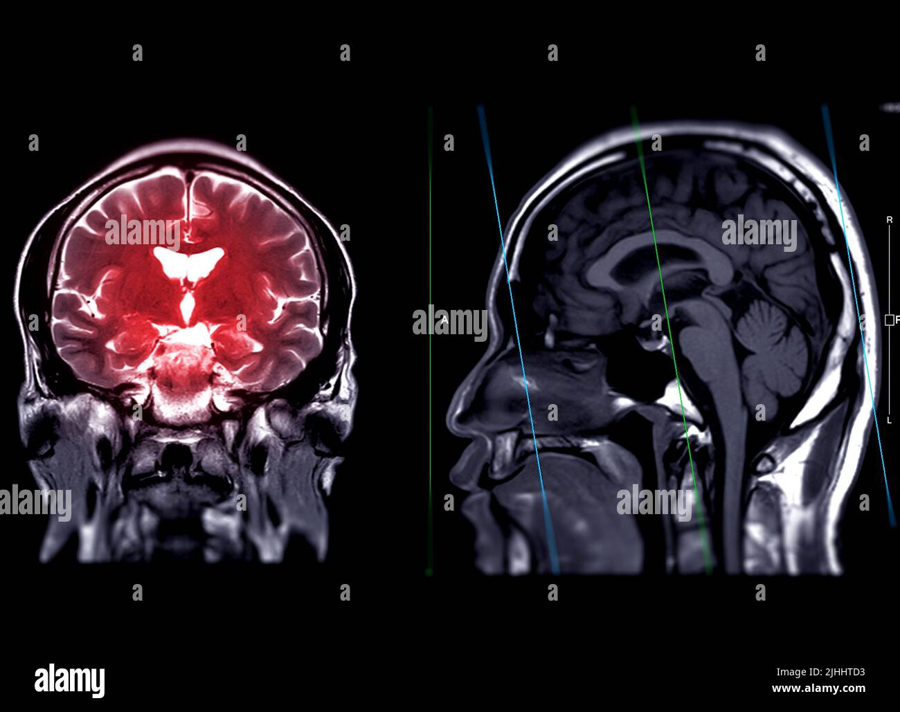 MRI brain coronal t2w and sagittal T1w technique for detect a variety ...