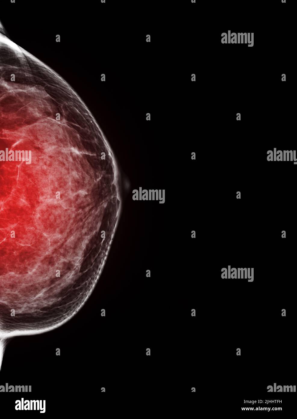 X-ray Digital Mammogram or mammography of the breast CC view for ...