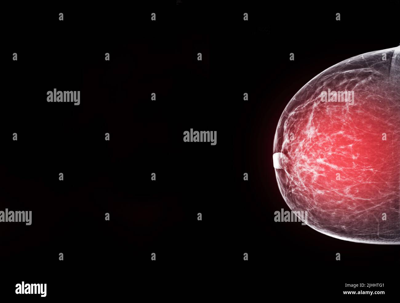 X-ray Digital Mammogram or mammography of the breast CC view for ...