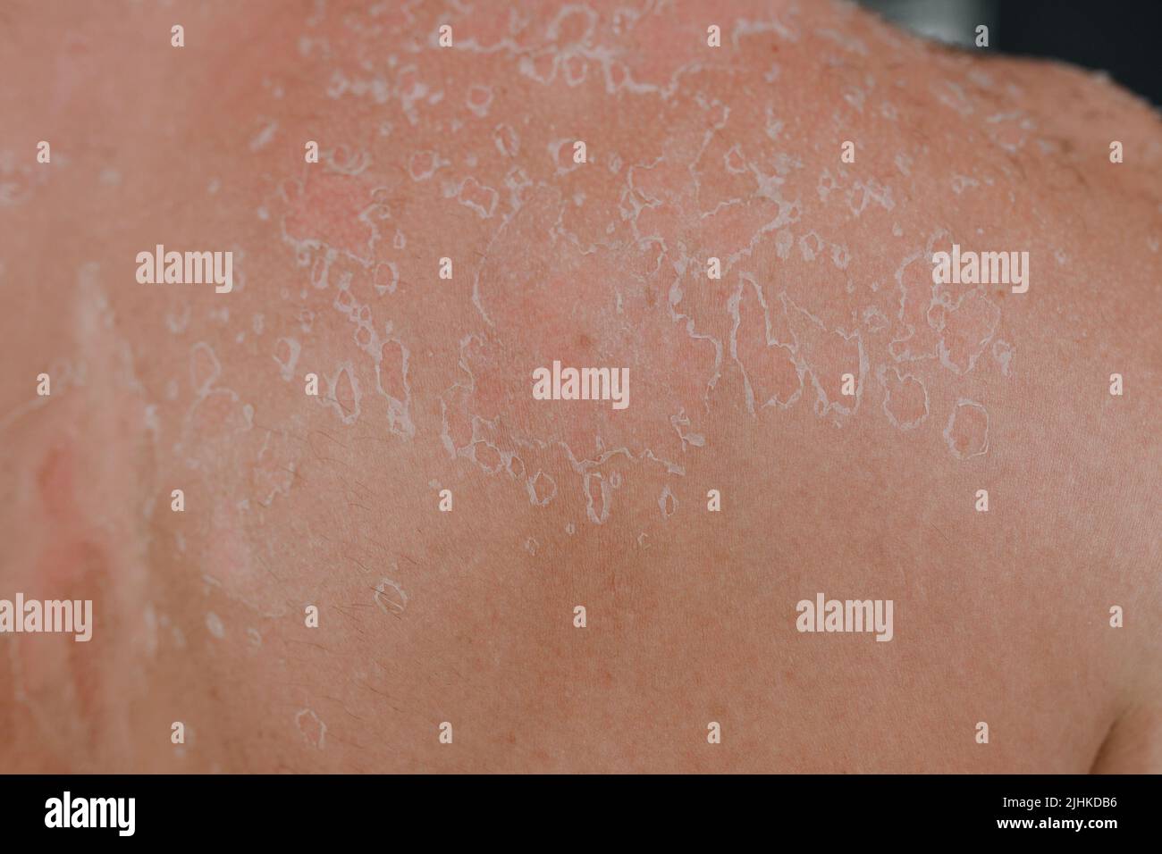 Skin texture background with flaking cell scales after sunburn and ...