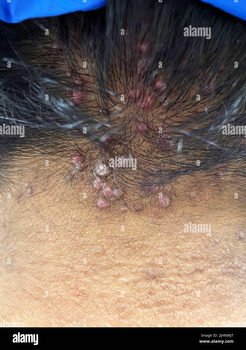 Acne keloidalis nuchae Stock Photo - Alamy