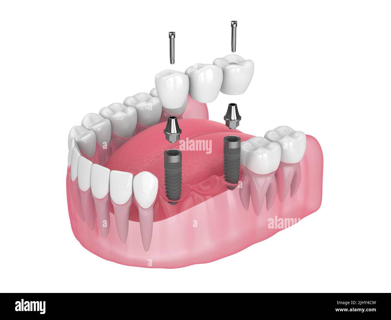 3d render of jaw with dental bridge supported by implants in jaw over ...