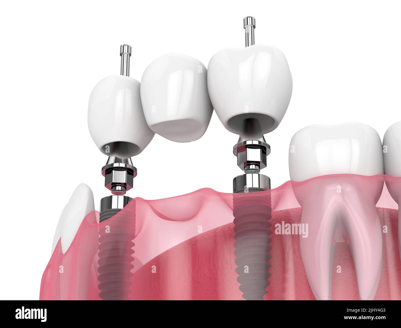3d render of jaw with dental bridge supported by implants over white ...