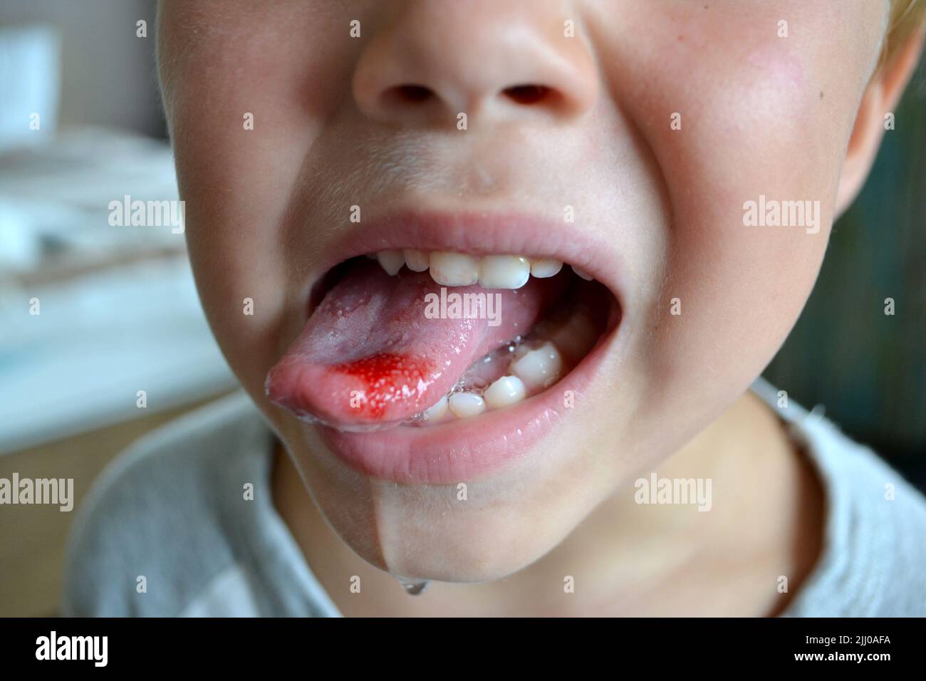 Child's bitten tongue. Close-up of lips, tongue, protrusion of blood ...