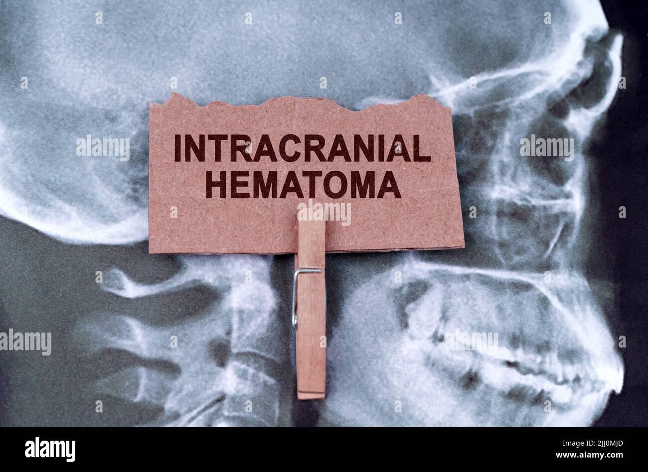 Medicine concept. Against the background of an X-ray of the skull, a ...