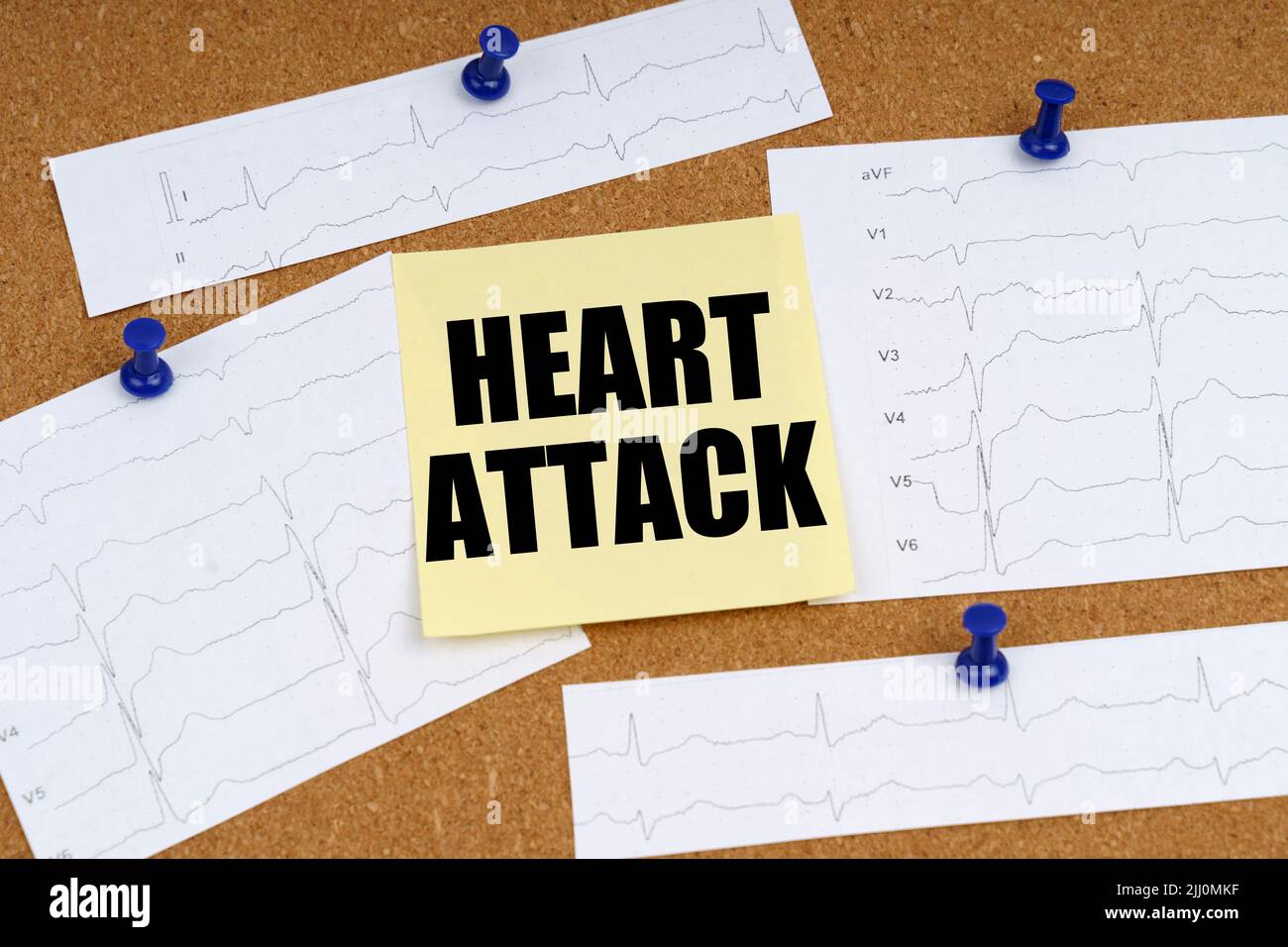 Medicine and health concept. Attached to the board are cardiogram ...