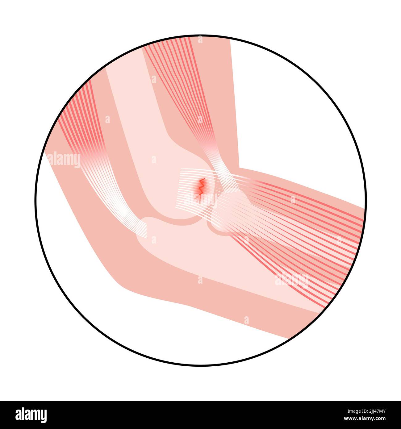 Illustration of tennis elbow, or lateral epicondylitis Stock Photo - Alamy