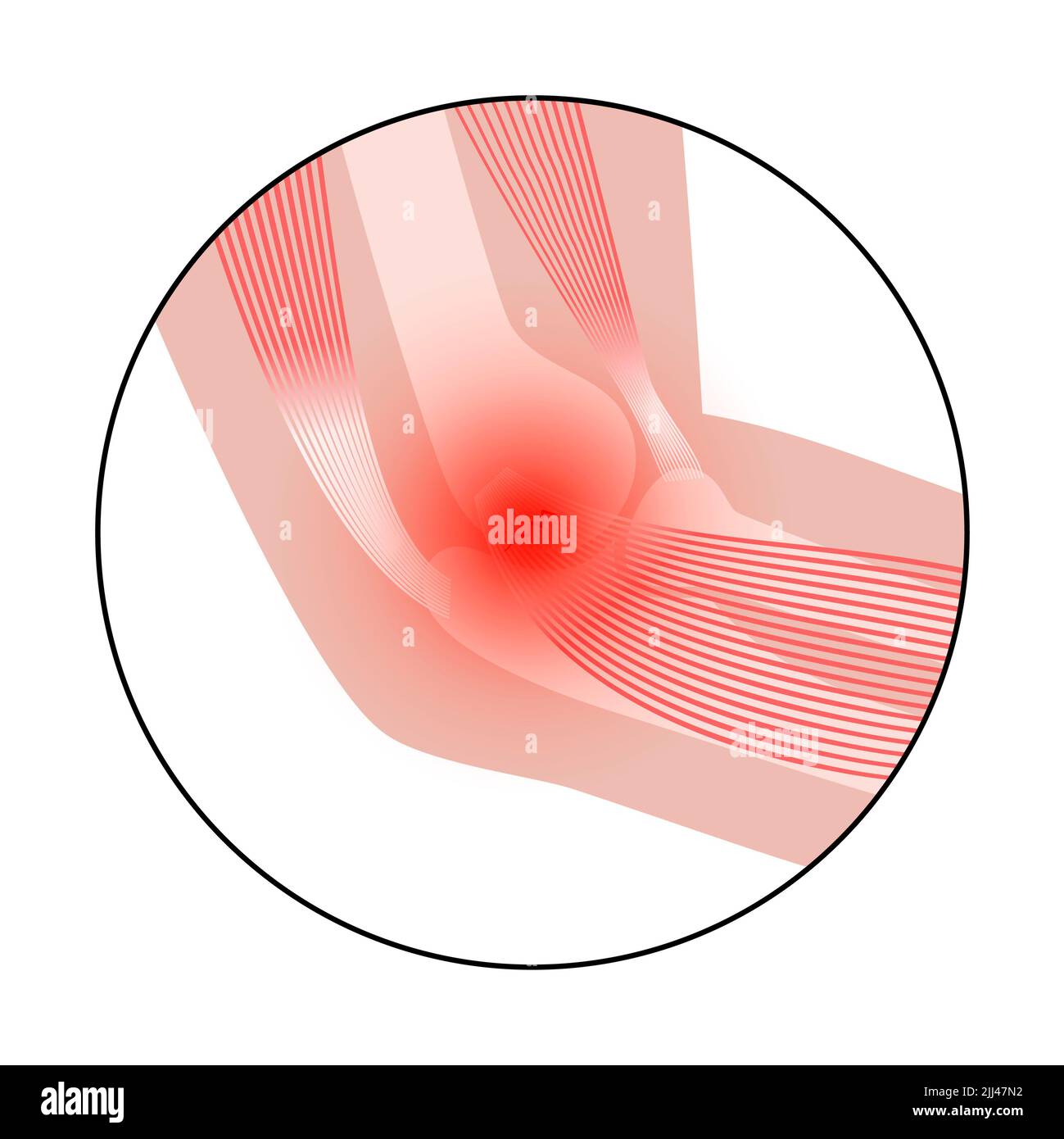 Illustration of golfer's elbow, or medial epicondylitis Stock Photo - Alamy