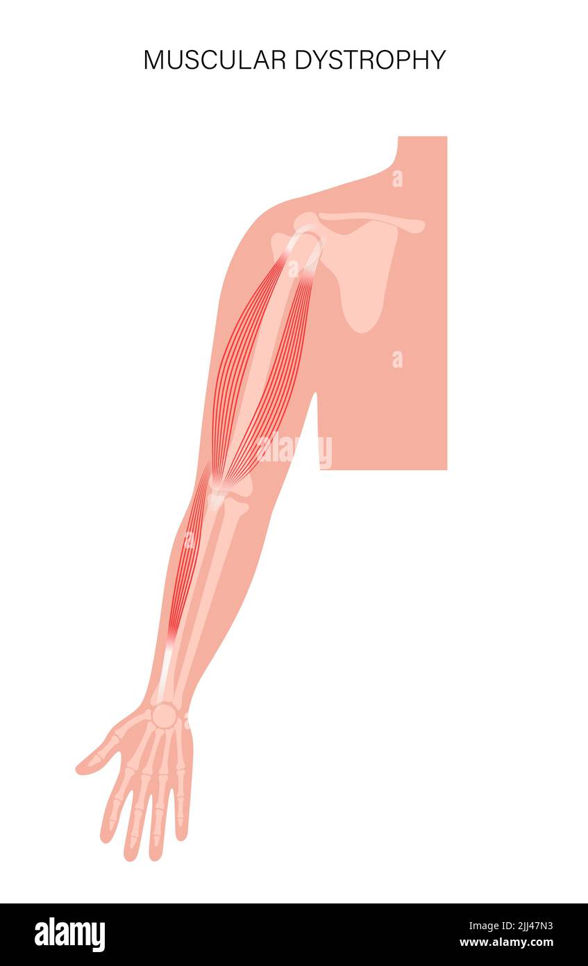Muscular dystrophy, illustration Stock Photo - Alamy