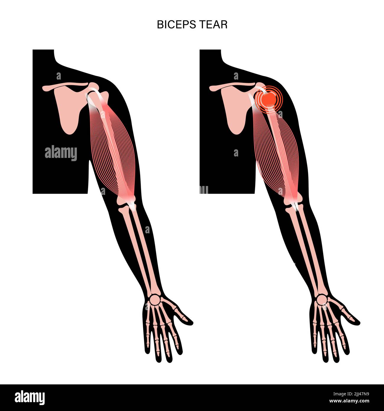 Biceps injury, illustration Stock Photo - Alamy