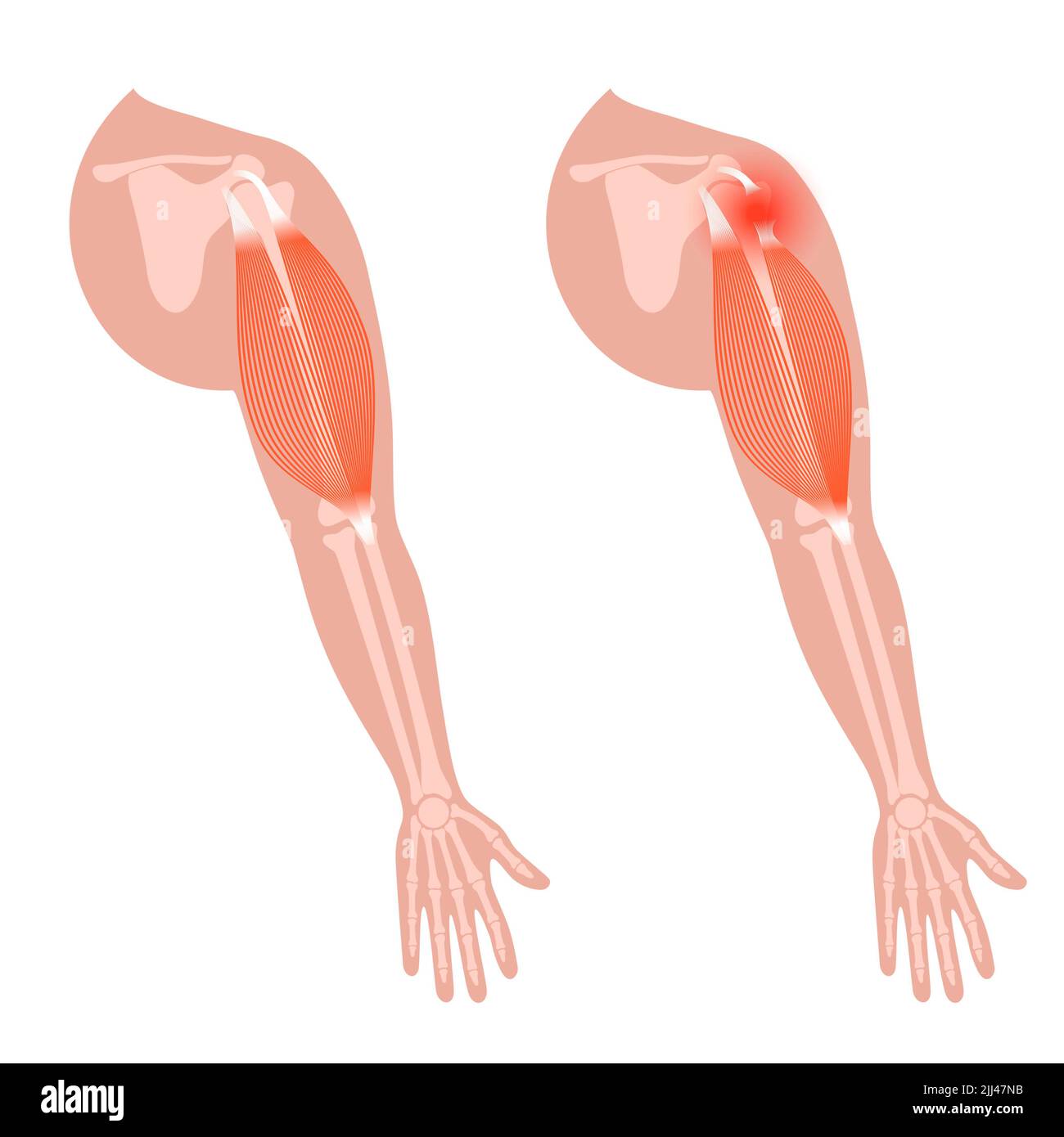 Biceps injury, illustration Stock Photo - Alamy