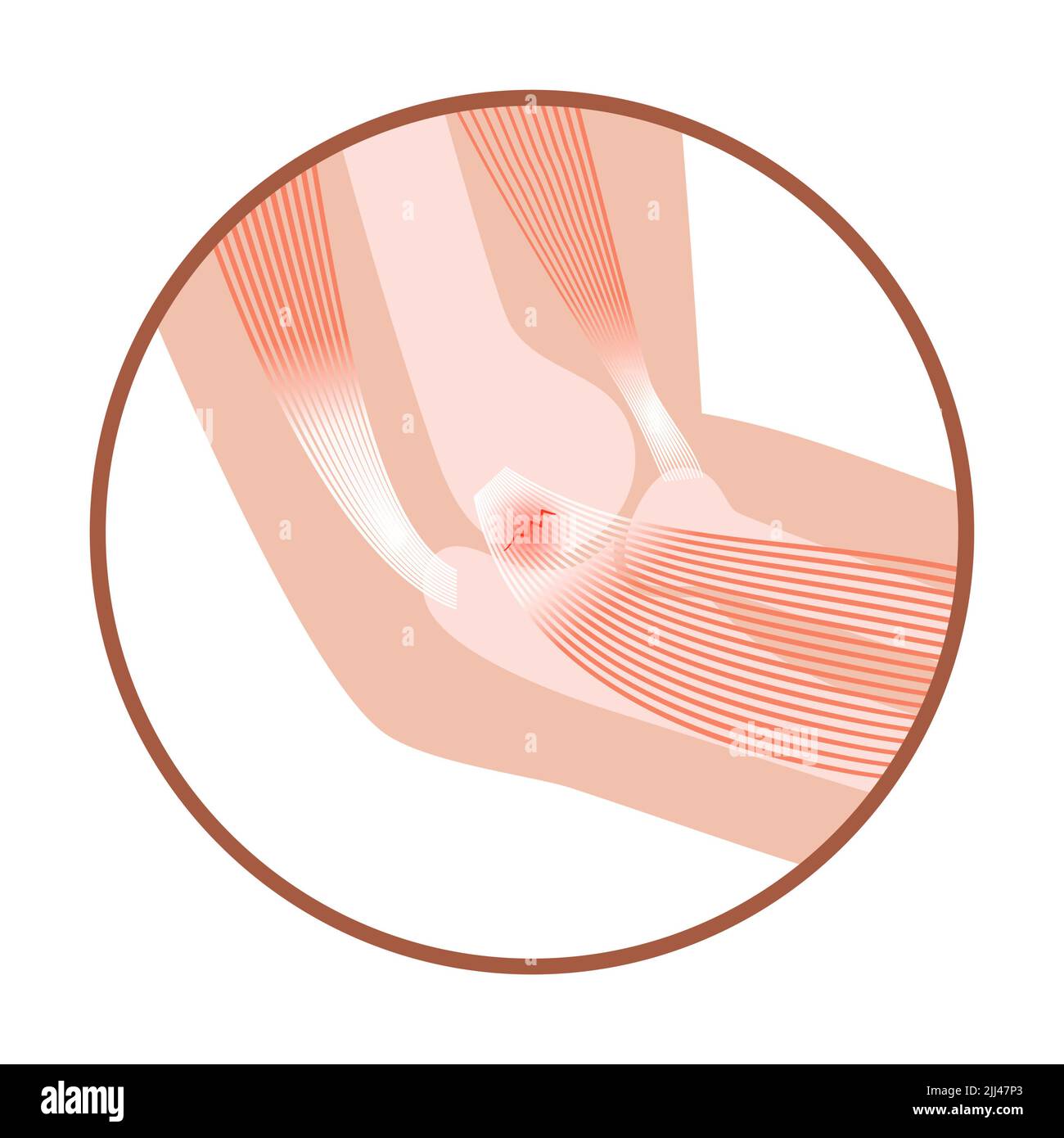 Illustration of golfer's elbow, or medial epicondylitis Stock Photo - Alamy