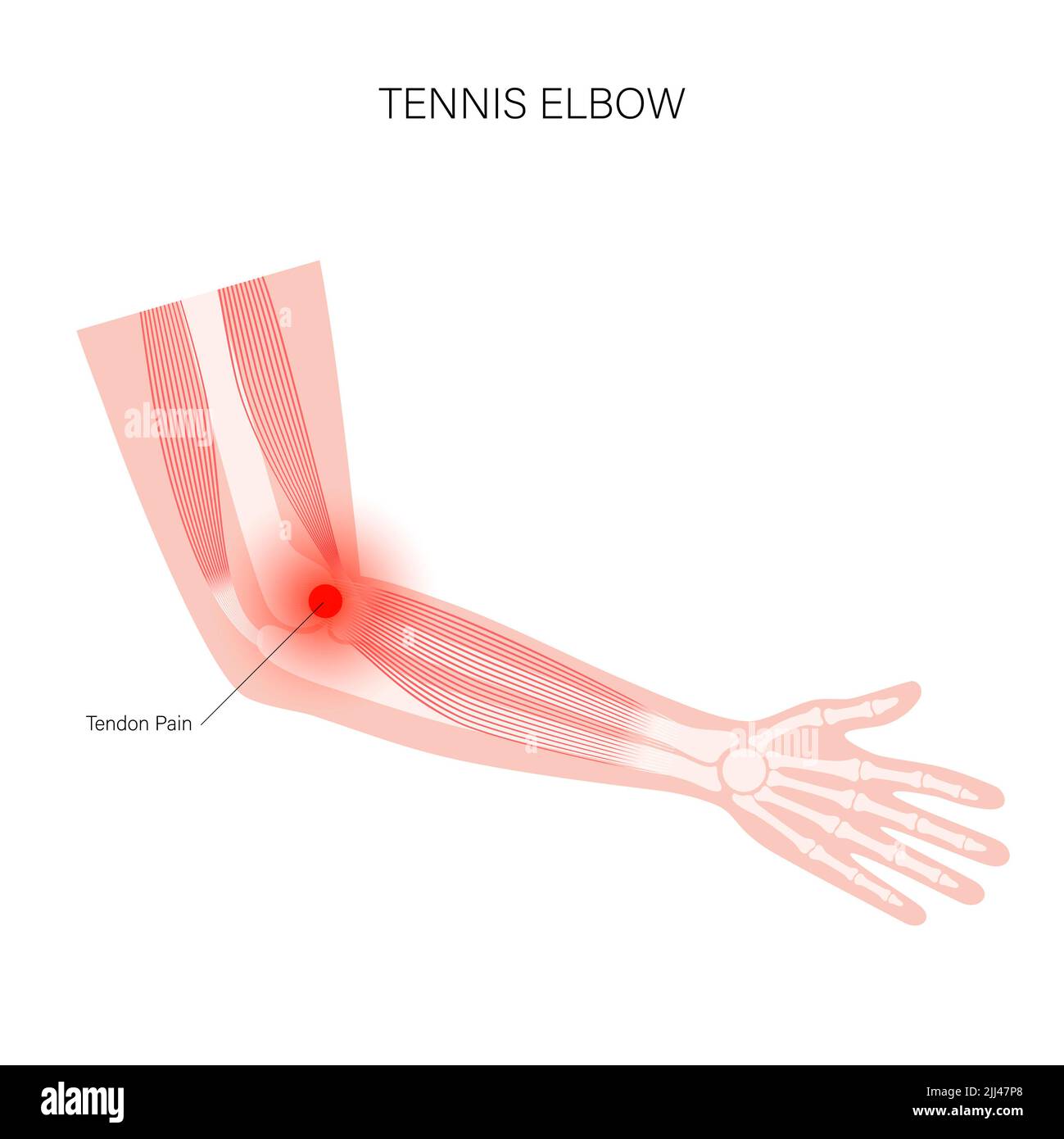 Illustration of tennis elbow, or lateral epicondylitis Stock Photo - Alamy