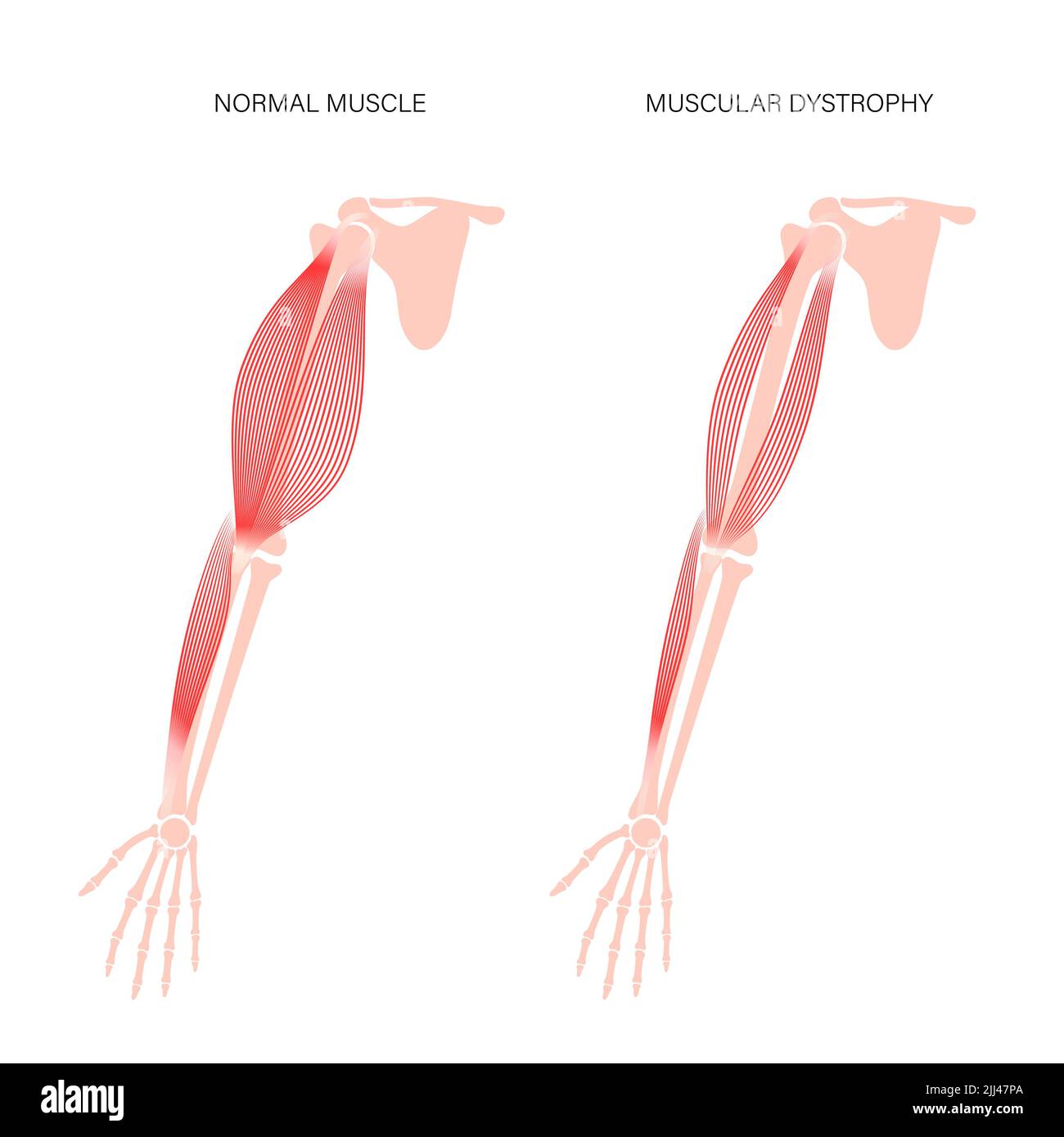 Muscular dystrophy muscle Cut Out Stock Images & Pictures - Alamy