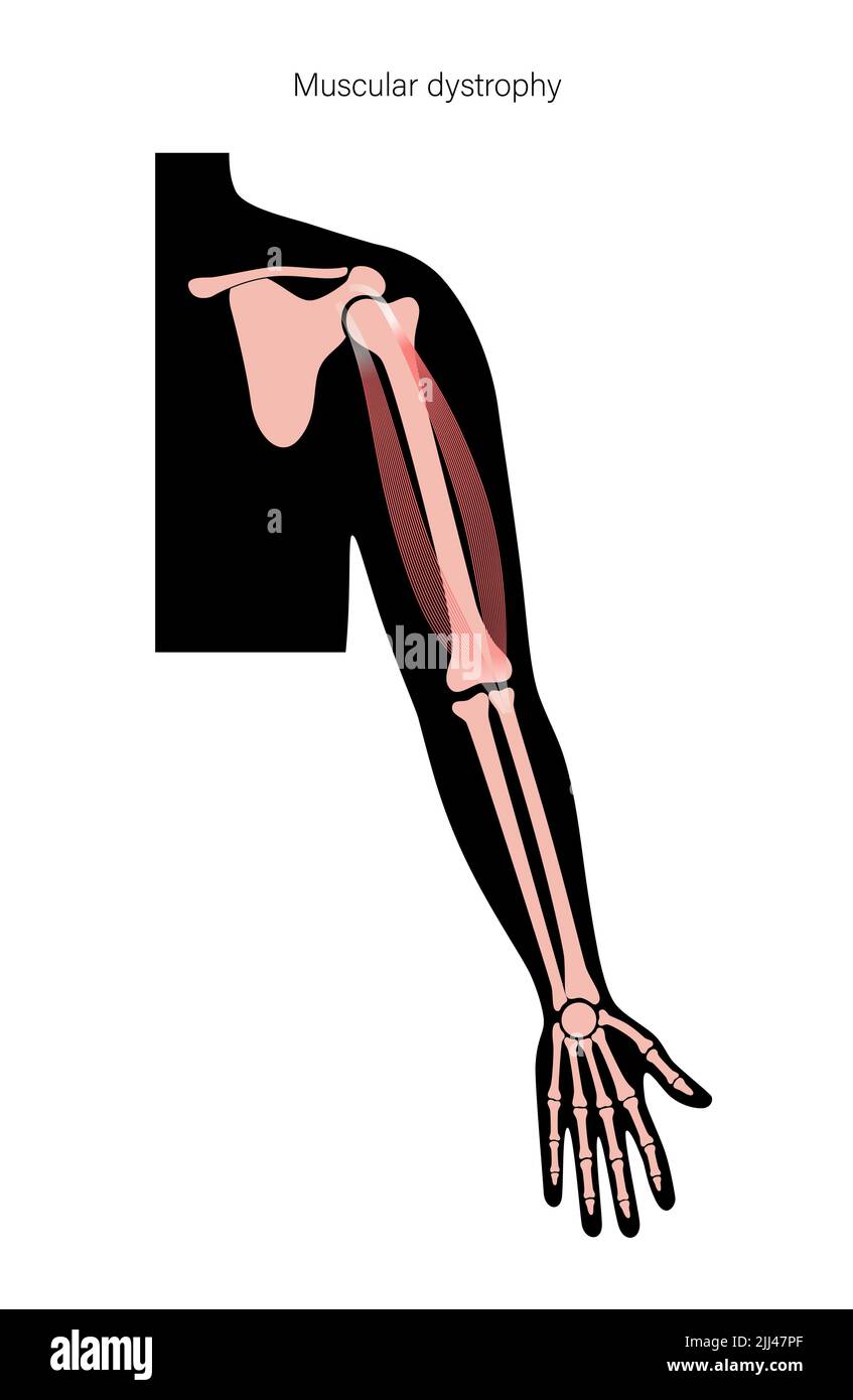 Muscular Dystrophy Graphics