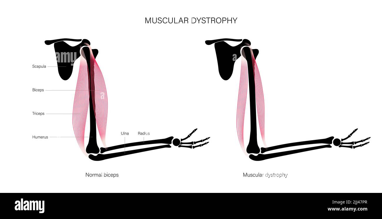 Muscular dystrophy hi-res stock photography and images - Alamy