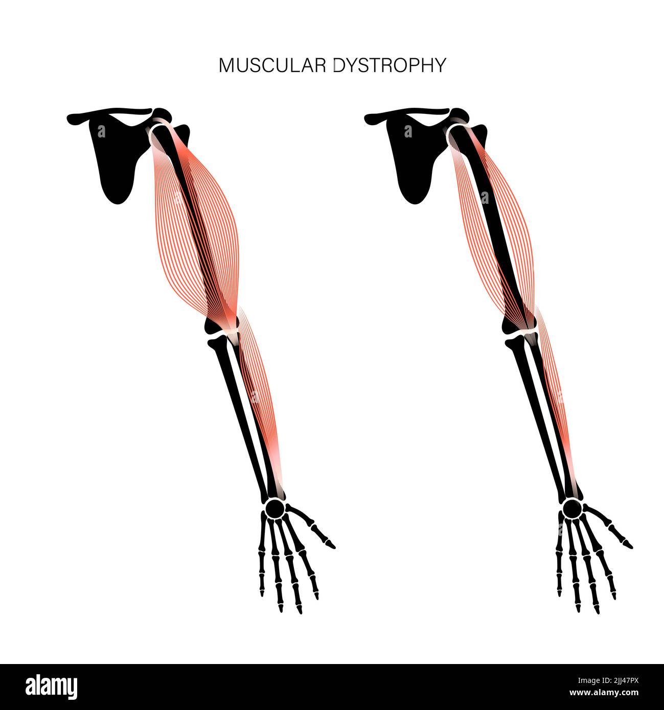 Muscular dystrophy, illustration Stock Photo - Alamy