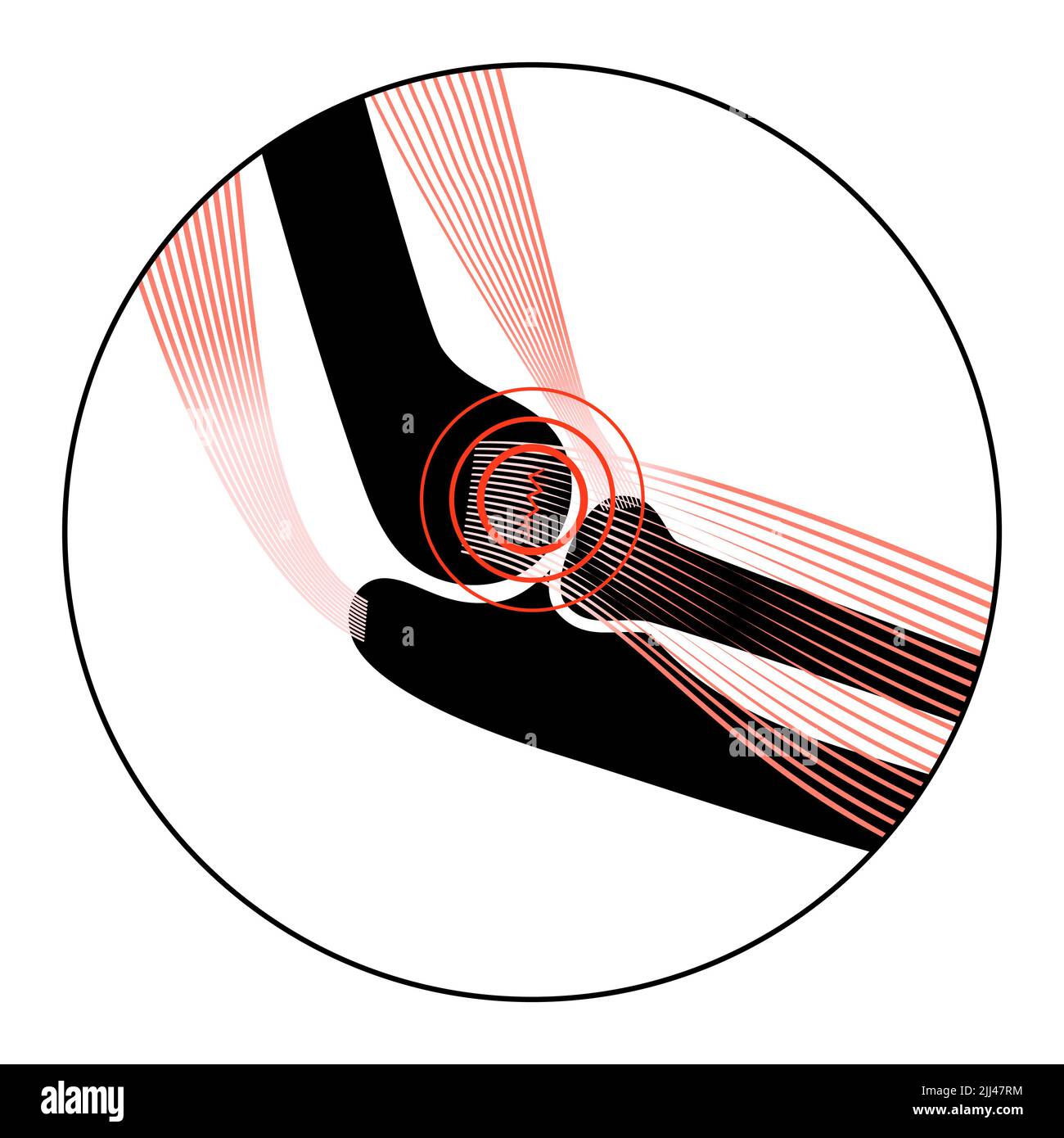 Illustration of tennis elbow, or lateral epicondylitis Stock Photo - Alamy