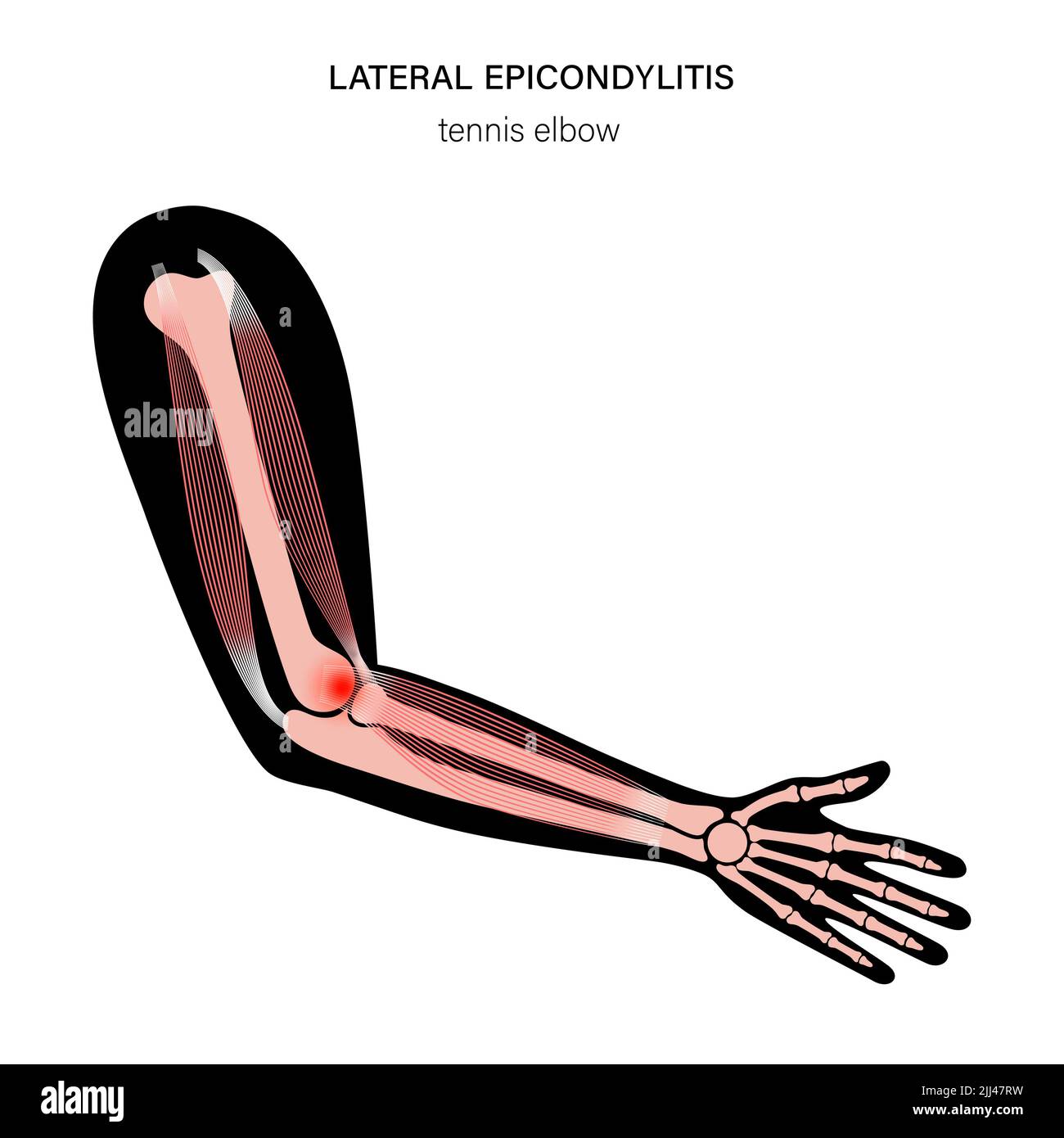 Illustration of tennis elbow, or lateral epicondylitis Stock Photo - Alamy