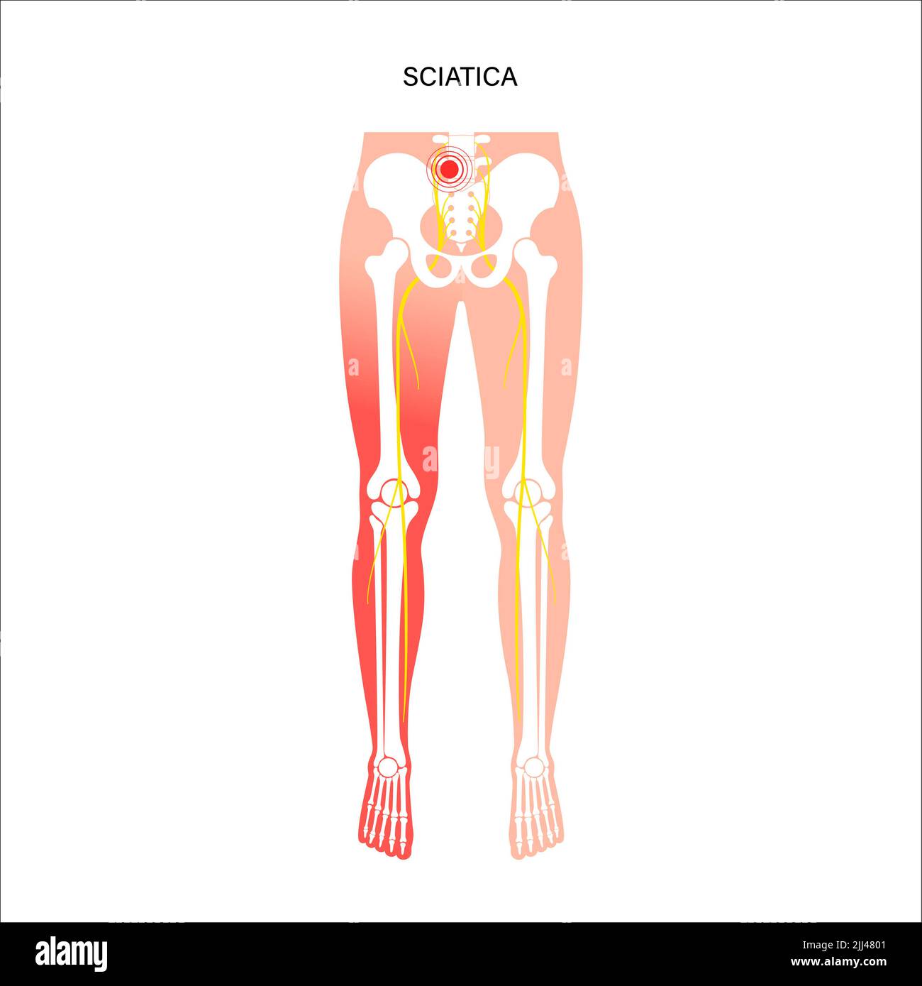 Sciatica diagram hi-res stock photography and images - Alamy