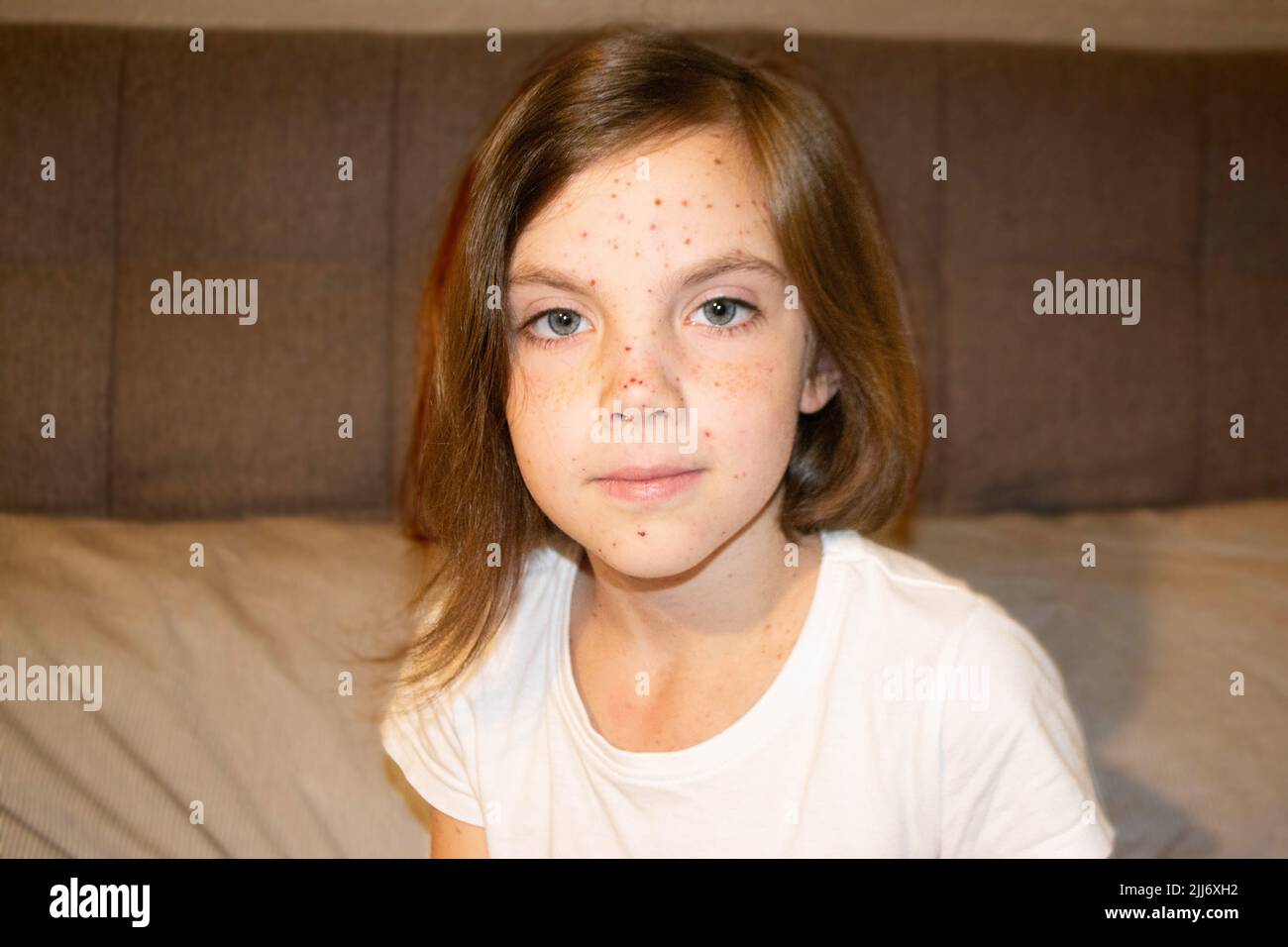 Natural vaccination. Contagious disease. Sick child with chickenpox ...