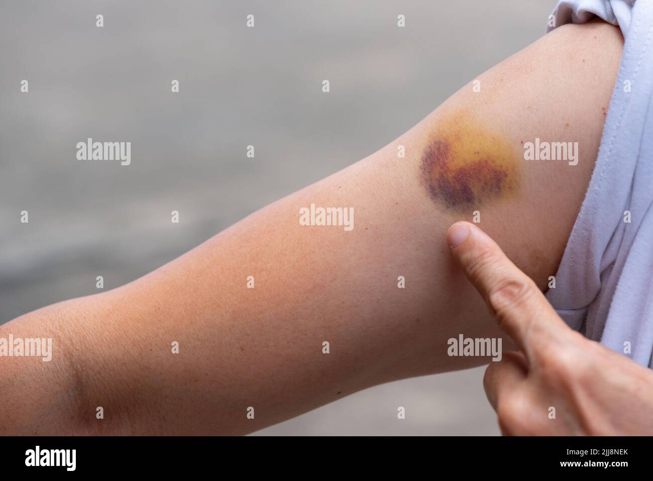 Hematoma arm hi-res stock photography and images - Alamy