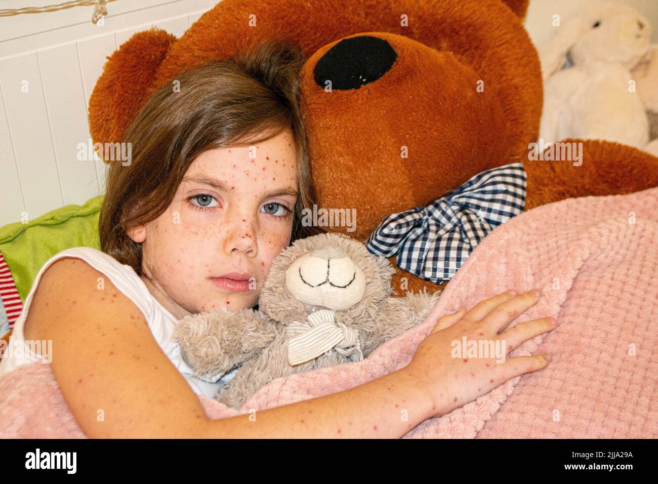 Natural vaccination. Contagious disease. Sick child with chickenpox ...