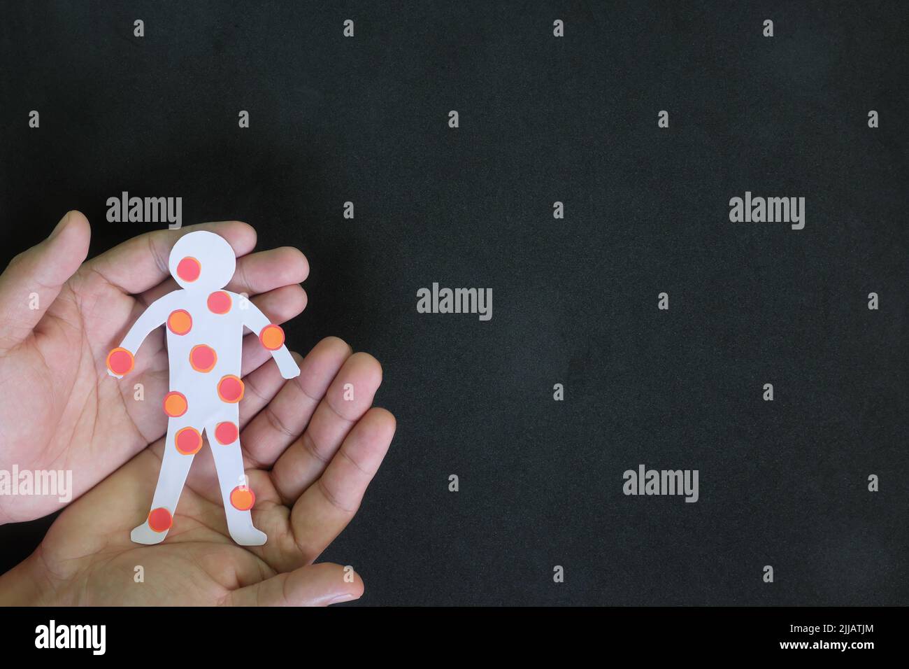 Pox disease such as monkeypox, smallpox and chicken pox care ...