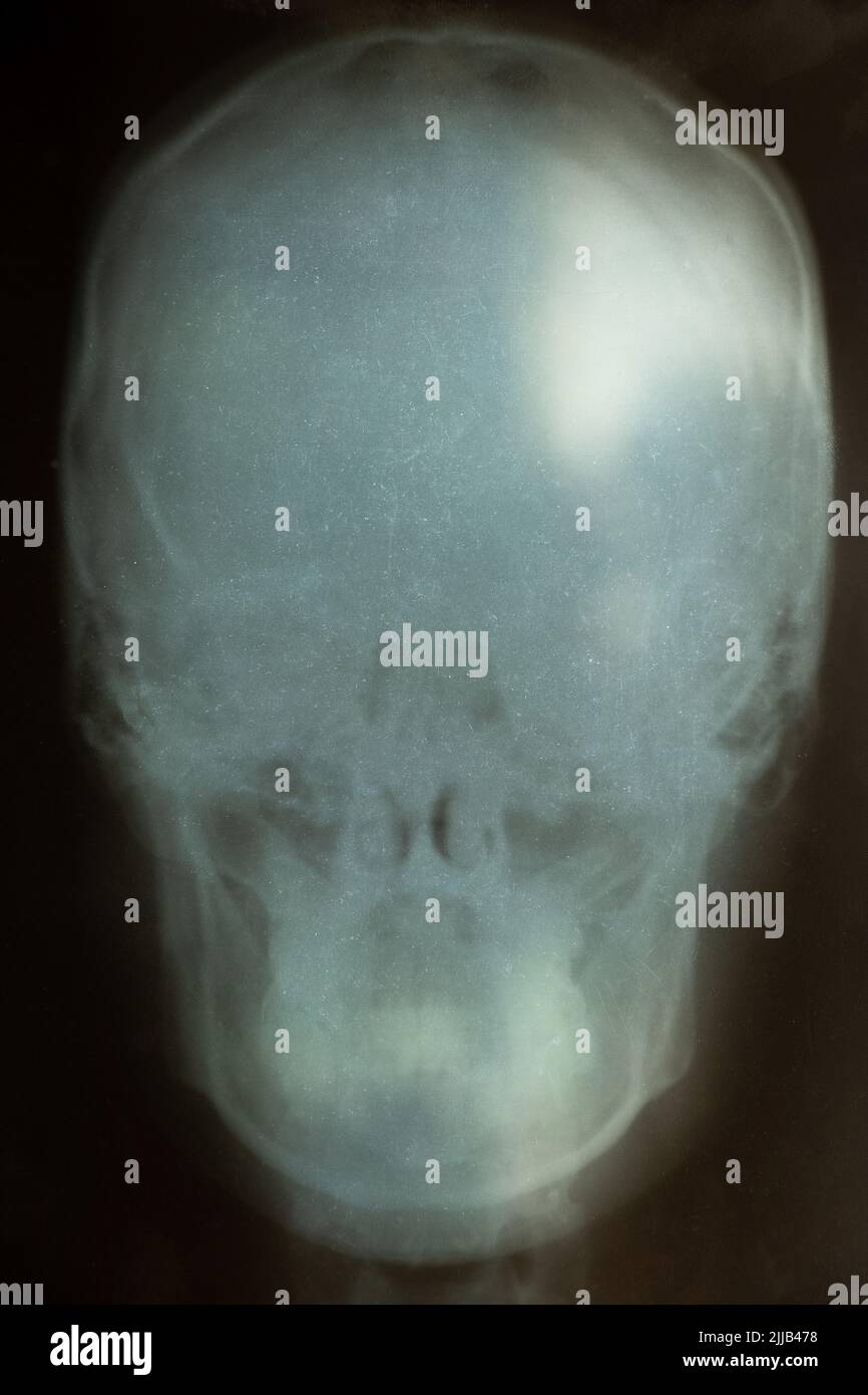 Old x-ray of a female skull close-up, examination of the skull ...