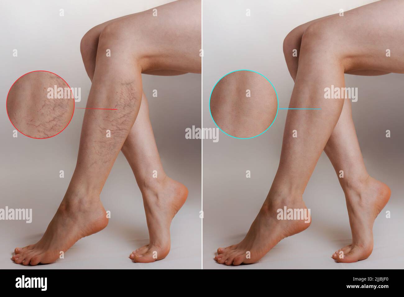 Medicine and health. The concept of female varicose veins. Female legs ...