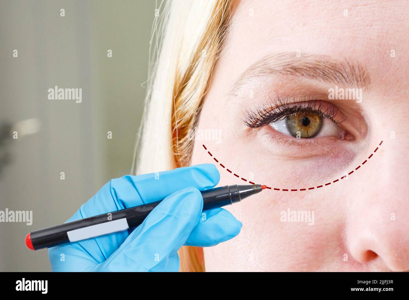 Plastic surgeon drawing dashed line under eye of girl. Hand in blue ...