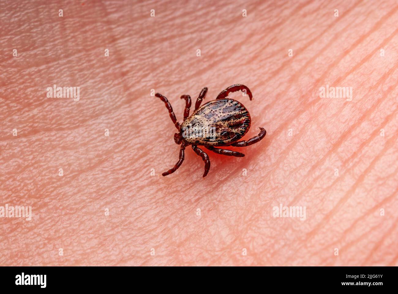 Infectious Encephalitis Tick Insect on Skin. Encephalitis Virus or Lyme ...