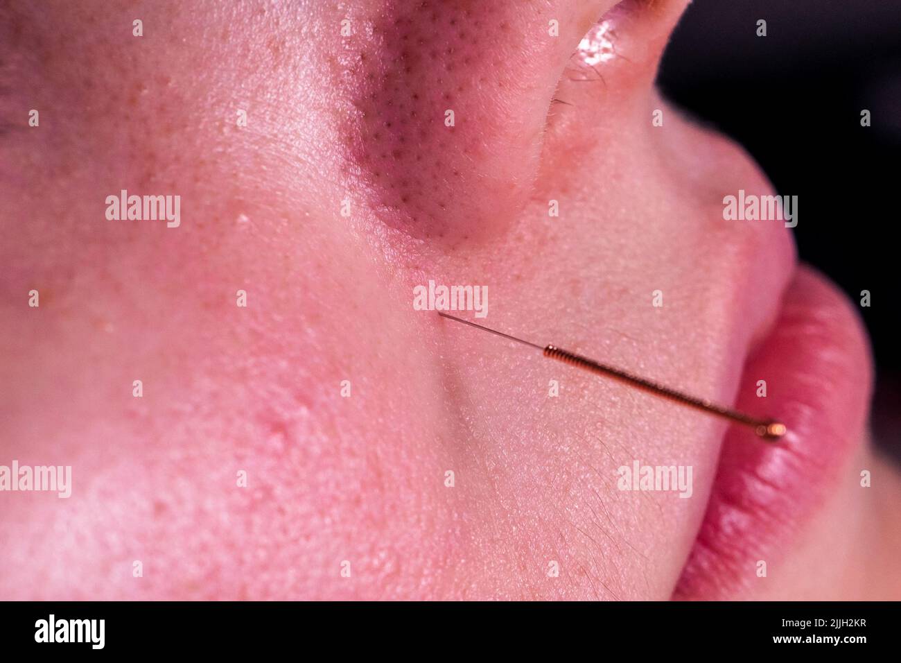 A macro portrait of a small acupuncture needle sticking in a person's ...