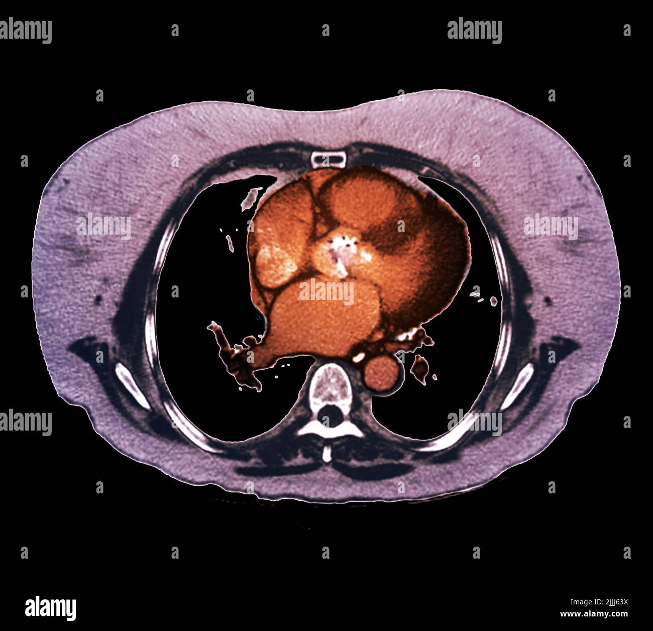 Heart failure, CT scan Stock Photo - Alamy