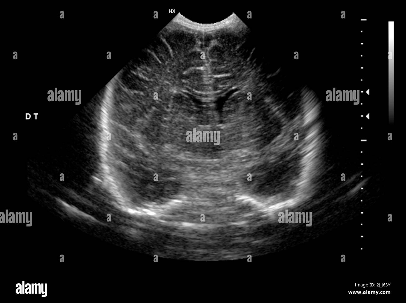 Normal premature newborn baby brain development, ultrasound Stock Photo ...