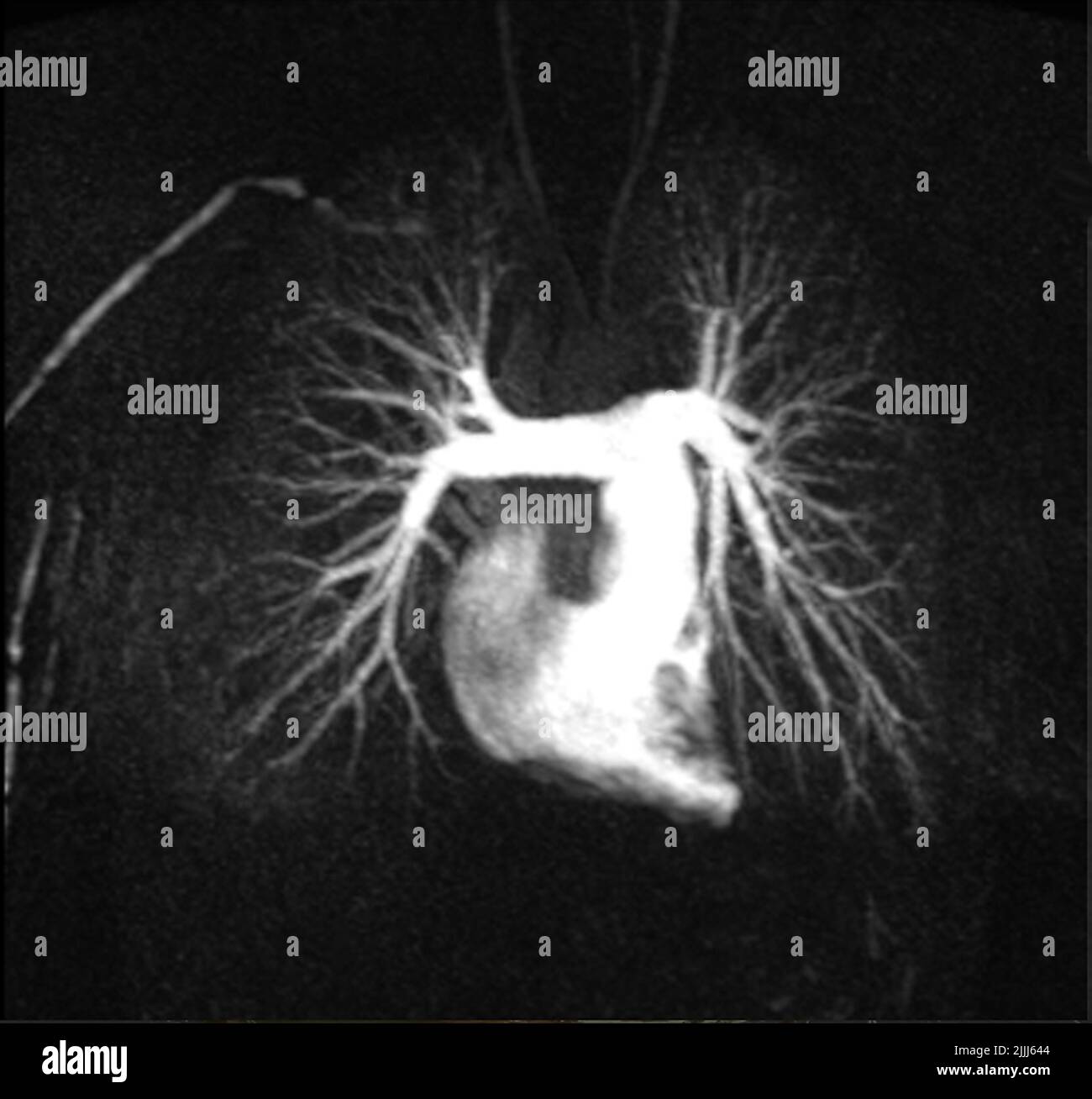 Heart and blood vessels, MRI angiogram Stock Photo - Alamy