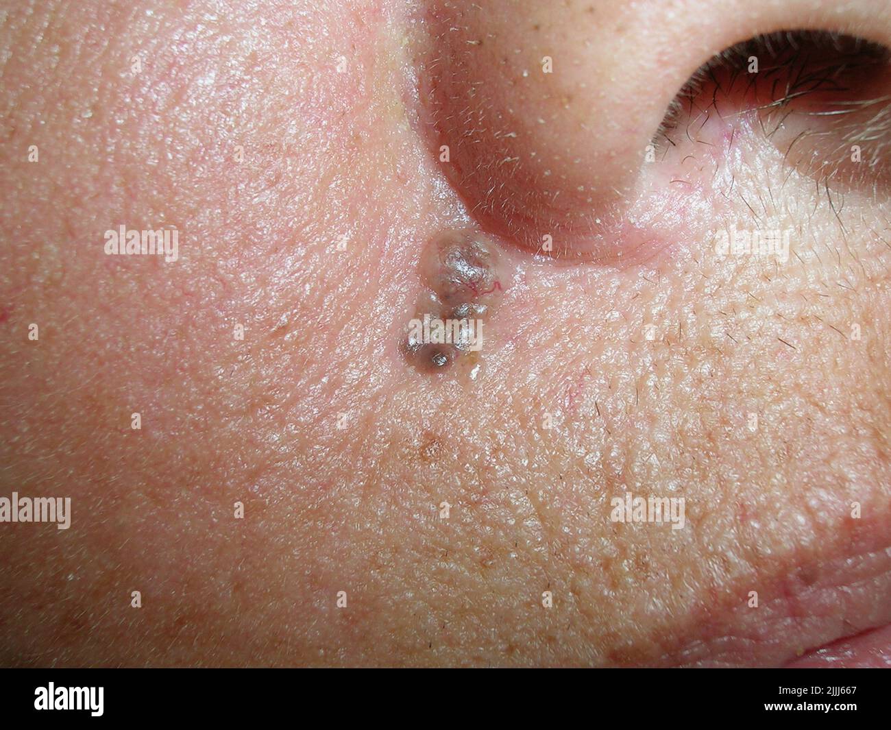 Nodular basal cell carcinoma Stock Photo - Alamy