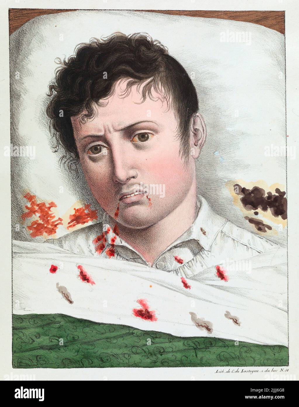 Yellow fever sequence, 19th century illustration Stock Photo - Alamy